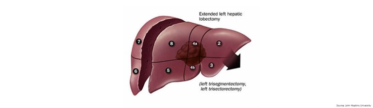 Liver Metastases - Bowel Cancer Treatment