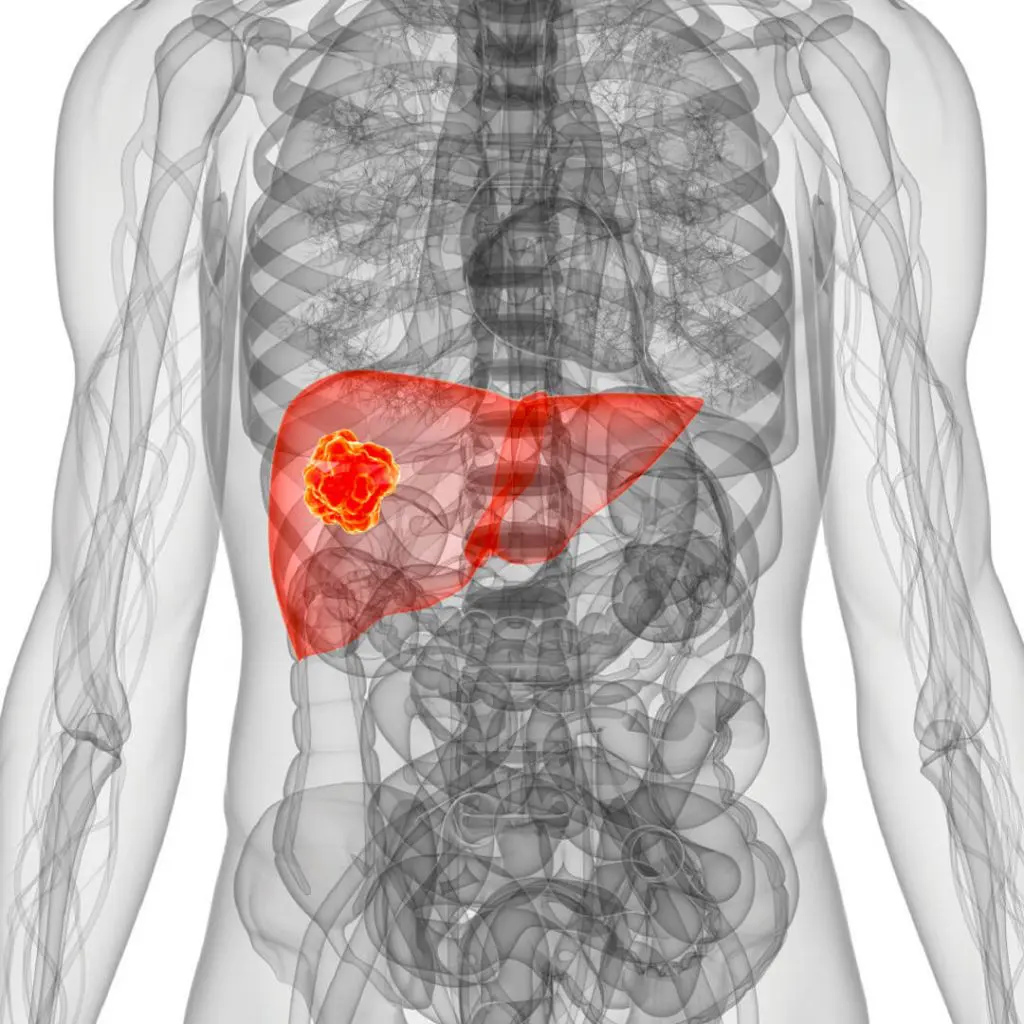 Liver And Colon Cancer Symptoms Colorectal Cancer | Mount Alvernia