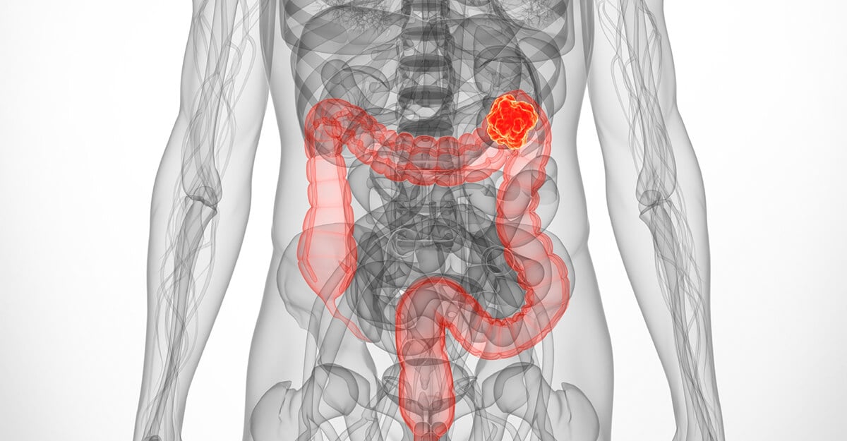 Bowel Cancer Australia - Awareness, Support & Research