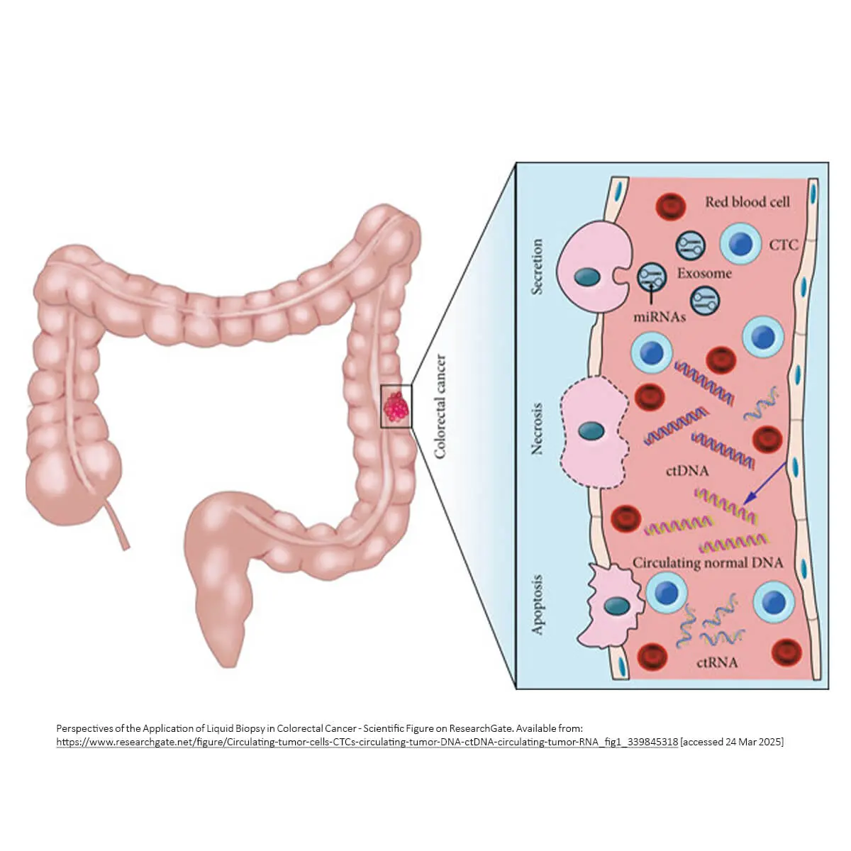 Rectal Cancer Diagram Bowel Colon Cancer Causes Symptoms 1376